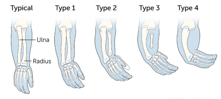 Radial longitudinal deficiency – Reach