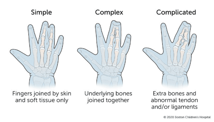 Webbed fingers (Syndactyly) – Reach