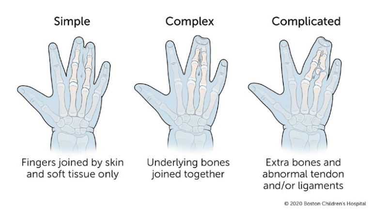 Webbed fingers (Syndactyly) – Reach