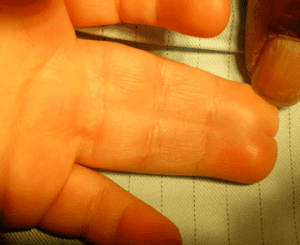 Webbed fingers (Syndactyly) – Reach