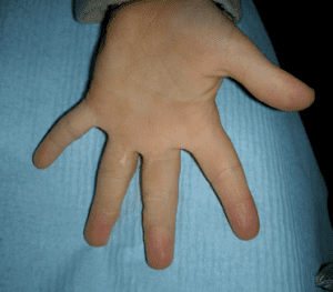 Amniotic Band Sequence (ABS) – Reach
